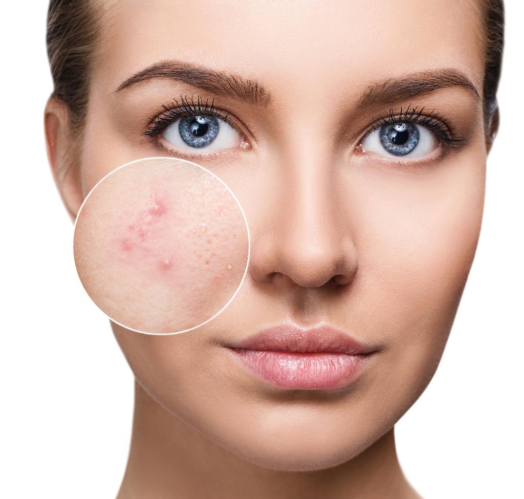 Acne scars - Revive Clinic
